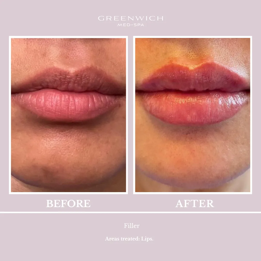 Lip Filler Injections | Greenwich Med Spa, CT, NY & NJ