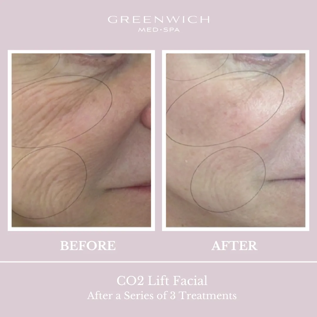 CO2 Lift Facial| Greenwich Med Spa